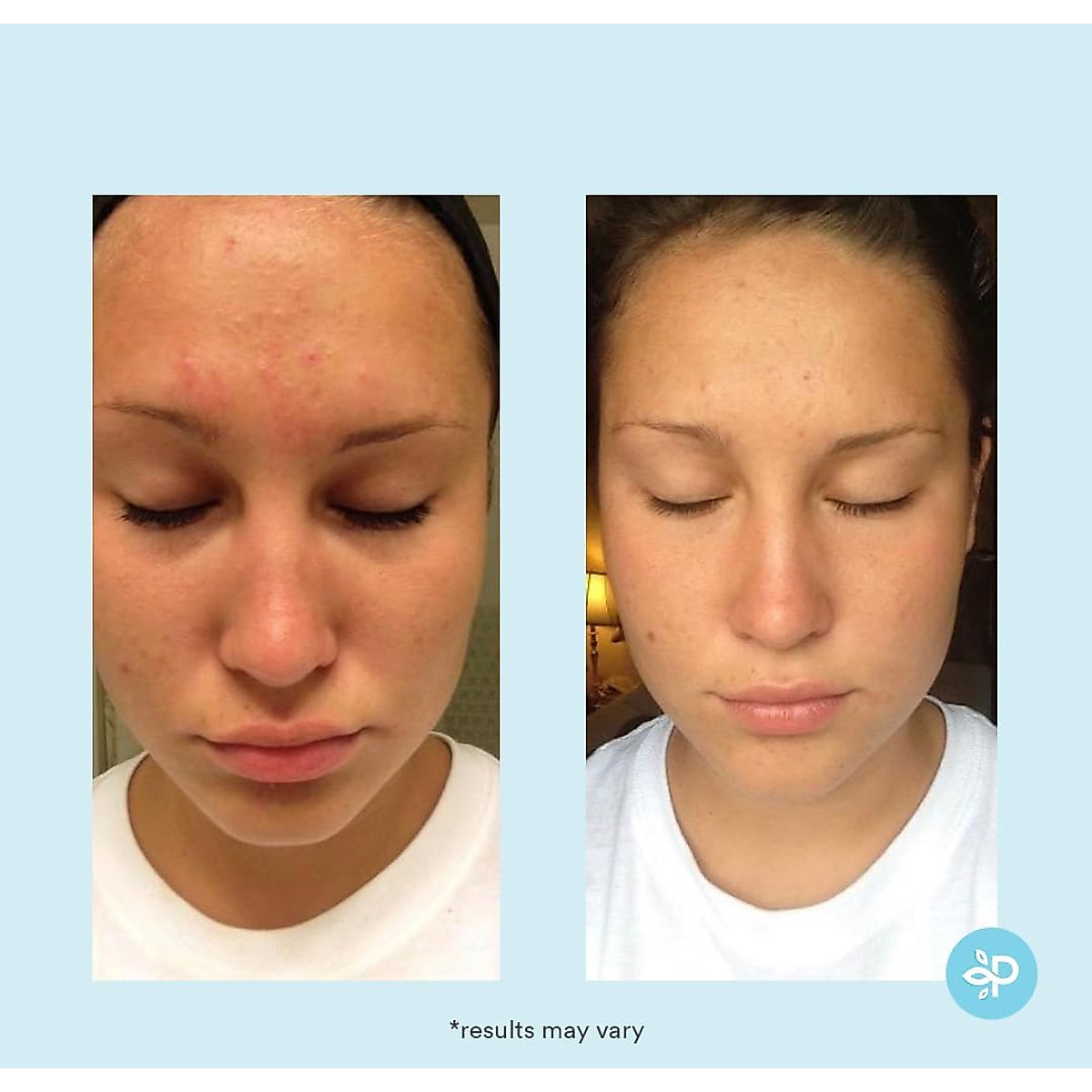 Glycolic Acid 30% Gel Peel - Enhanced with Retinol and Green Tea Extract (Professional Chemical Peel)- 1 fl oz 30mL