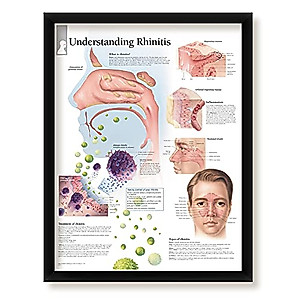 Set of 4 Framed Medical Posters Ear, Nose and Throat, Understanding Sinusitis, Understanding Rhinitis, and Middle Ear Infections 22"x28" Wall Diagrams