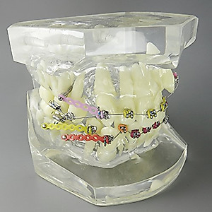 Smile1000 Dental Malocclusion Orthodontic Treatment Teeth Model with Metal Brackets Wires Colorful Ties Chains and Hoops M3005