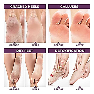 Foot Exfoliator Peeling Mask for Dry Cracked Feet - 3 Pack - Remove Dead Skin and Toxins with Lavender Foot Detox Effect - Foot Peel Mask for Baby Soft Feet by Lavinso