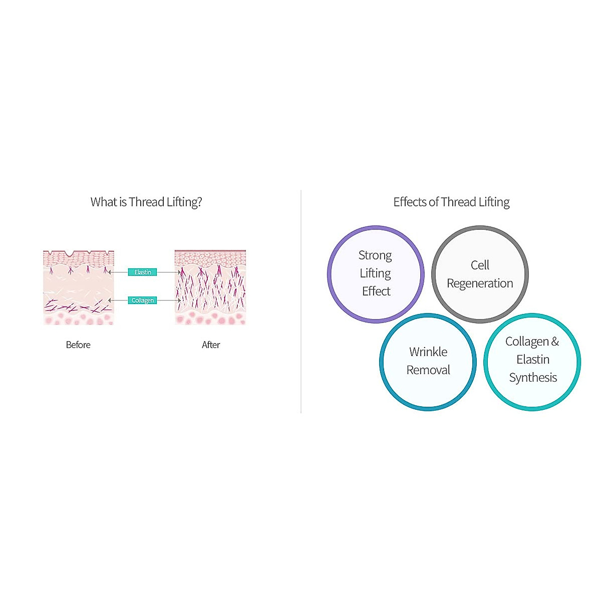 NeoGenesis PDO Combi Cog Threads for Face and Body Lift 20PCS (21G X 60MM)