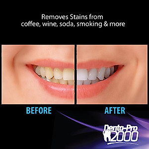 Teeth Whitening Kit - Professional At Home Teeth Whitening - Denta-Pro2000 It's Safe & Affordable - Get Whiter Teeth After Just One Use!