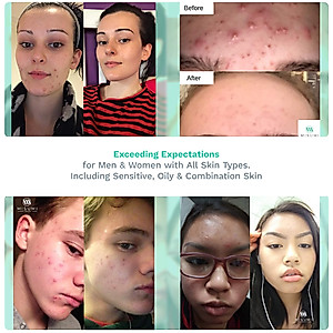 AHA Glycolic Acid 10% Acne Face Wash to Help Clear Clogged Pores - Anti-Aging Acne Skincare Glycolic Acid Face Wash with Natural Ingredients - Acne Cleanser Glycolic Face Wash - Acne Control Cleanser