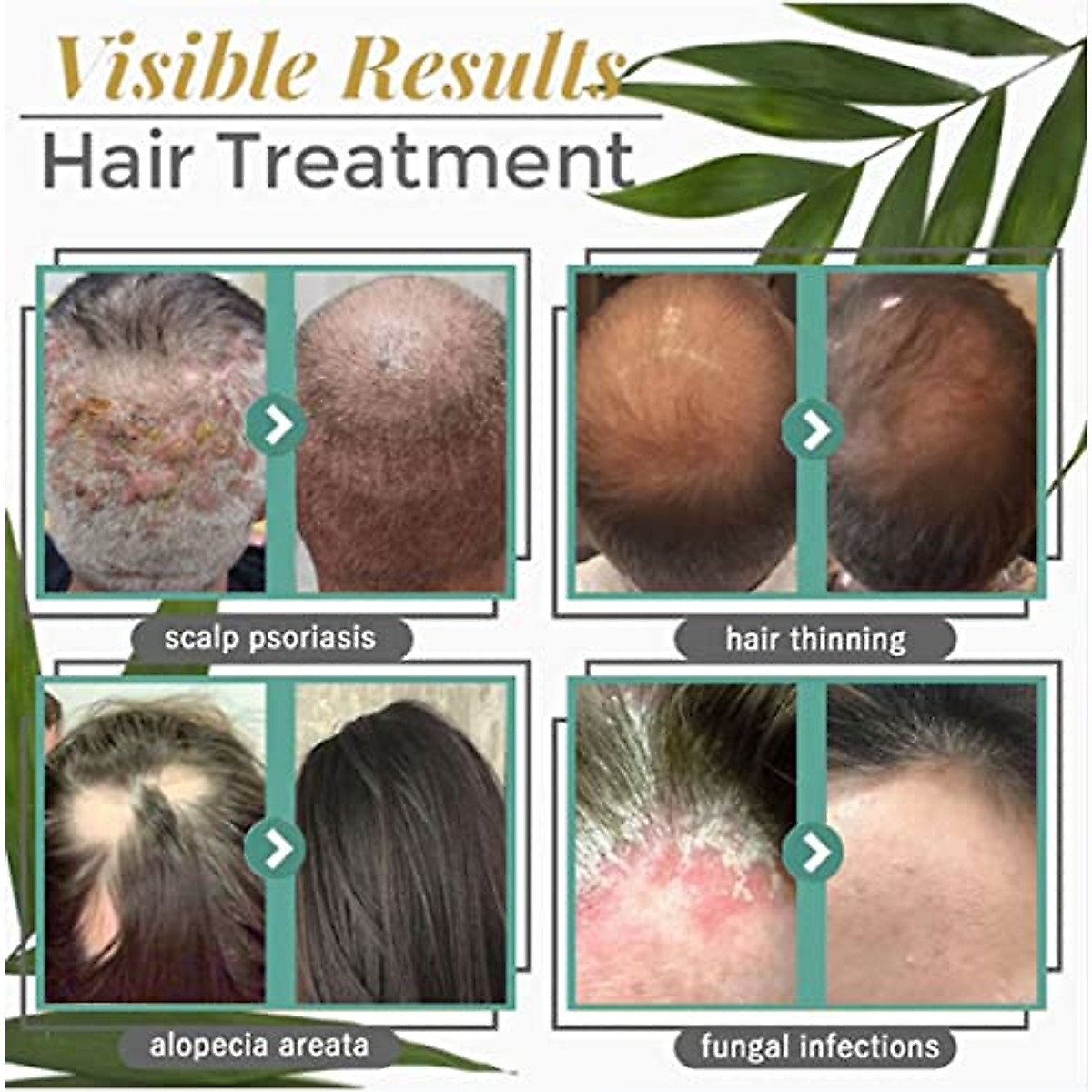 CPO Fᴏlliᴄle Nᴏᴜrishing HairGrᴏᴡth Serᴜm, Hair Growth Oil, Hair Serum for Thicker, The Hair Revival Serum, Hair Loss & Hair Thinning Serum, Hair Growth Serum for Men Women, 30ml