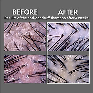 LA'DOR Anti-Dandruff Shampoo (16.9 fl.oz.) - For Oily Scalp with Dandruff, Gently Cleanses Away Dead Skin Cells, Alleviates Itching and Irritation LADOR