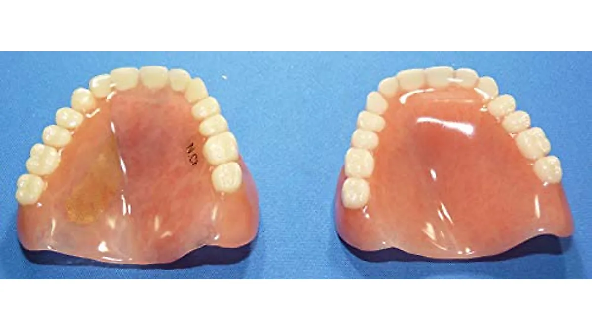 Denture Repair Lab - Duplicate Denture - Denture Clone - Denture ...