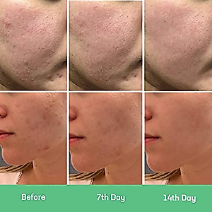 Azani 10% Lactic Acid + Squalane Resurfacing - 1.01 Oz Serum | Face Exfoliating AHA to Soften and Smooth Skin, Brighten Complexion and Diminish Fine Lines & Wrinkles - Women & Men