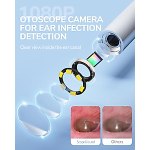 ScopeAround Otoscope Ear Camera, Ear Wax Removal Tool 1080p FHD Video Otoscope, 3.9mm Ear Wax Removal Camera with 6 LED Lights Visual Ear Scope, Compatible with iPhone15 & Android