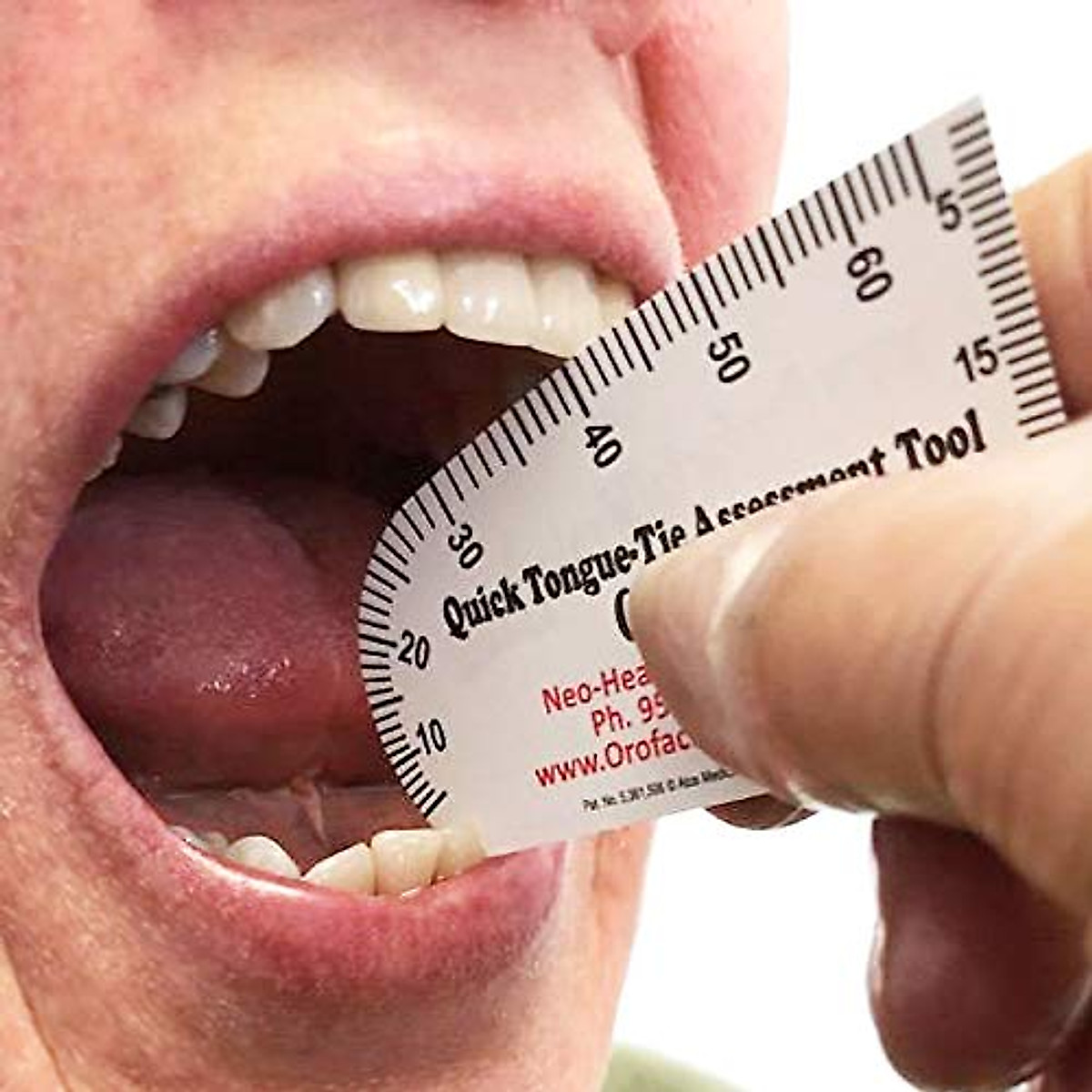 Quick Tongue Tie Assessment