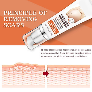 Stretch Mark Cream, Scar Cream Removal Cream Scars Essence Stretch Mark Repair Cream Stretch Scars Remove Acne Cream Stretch Mark Treatment Maternity Repair