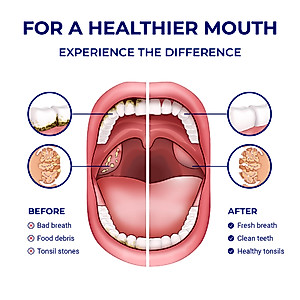 ORAVIX Dental Water Flosser, Tonsil Stone Remover, Gentle Oral Irrigator for Sensitive Teeth and Gums, Kids Manual Water Flosser, No Electricity or Batteries