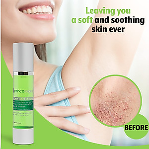 Princereigns Ingrown Hair Serum - Organic Razor Bump & Redness Solution for Men & Women, Ideal for Face, Bikini, Legs, Underarm, Prevents Future Ingrown Hairs, No Alcohol or Oils - 2 Fl. Oz