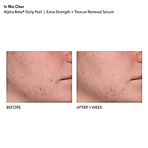 Dr. Dennis Gross In The Clear Retinol + AHA/BHA SetL Alpha Beta Extra Strength Daily Peel (14 Packettes) + Advanced Retinol + Ferulic Texture Renewal Serum (full size 1 oz)