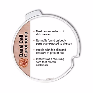 GPI Anatomicals - Skin Cancer Model, Replica with Precancerous and Cancerous Skin Lesions for Human Anatomy and Physiology Education, Anatomy Model for Doctor's Office, Medical Study Supplies