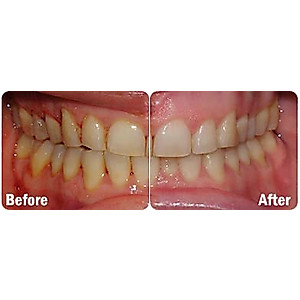 ProBiora Professional Strength Oral Probiotics for Teeth and Gums | Dental Probiotic for Oral Health | Bad Breath Treatment for Adults | Tooth Whitening | ProBiora3 Probiotic Blend | 90 Orange Tablets