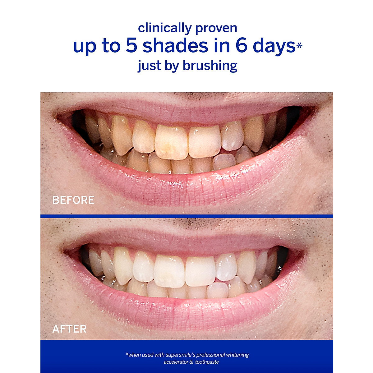 Supersmile Professional Teeth Whitening System , 1 Count (Pack of 1)