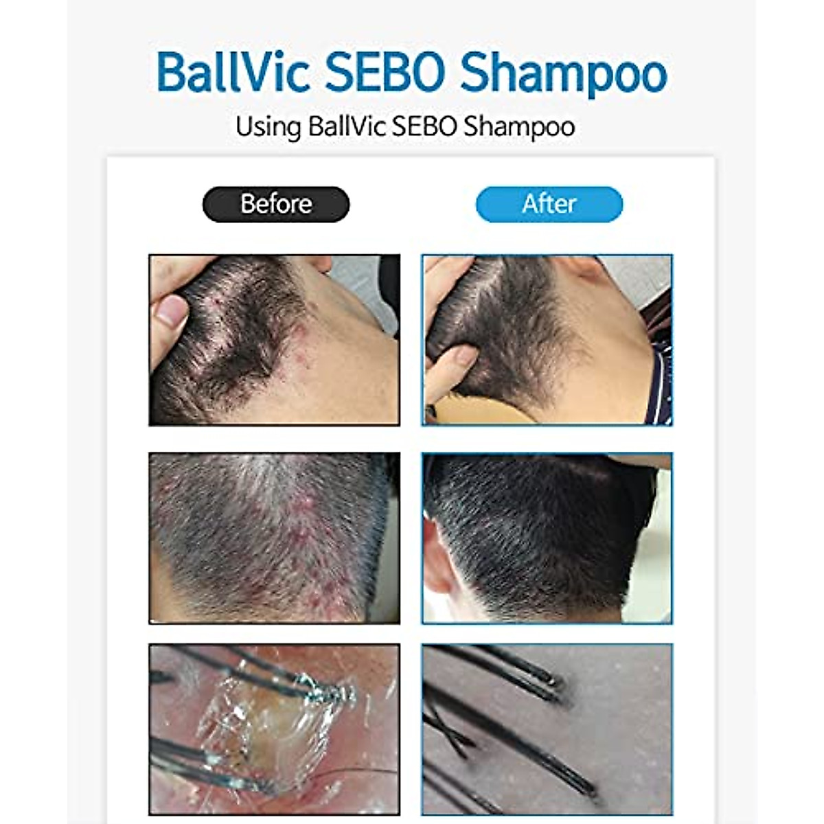 BallVic Sebo Shampoo - Itchy Scalp Trouble Care Dandruff Treatment Hair Loss Shampoo for Seborrheic Dermatitis Eczema Men and Women 2.8 Oz (230g)