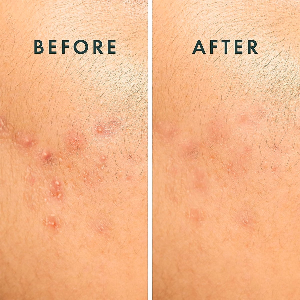 Rael Pimple Patches, Miracle Spot Control Cover - Hydrocolloid Acne Patch, Strips for Zits and Blemish, Korean Skin Care, Vegan, Cruelty Free (10 Count)