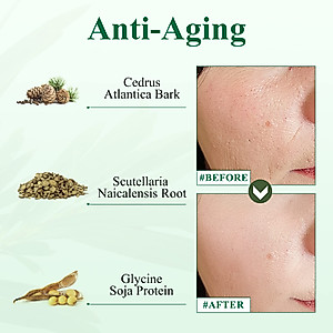 Tea Tree Oil Acne Serum, BREYLEE 2.0 Treatment Acne-Prone Sensitive Skin Care Face Serum to Cystic Acne Scars, Redness Relief, Pimples Dark Spots Remove, Niacinamide Facial Moisturizer,30ml/1.01fl oz