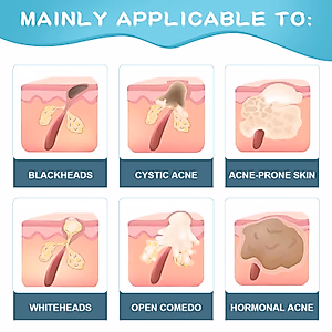 Paradise Emerald Cystic Acne Spot Treatment, Hormonal Acne Treatment for Face，Back and Body, with Salicylic Acid and Tea Tree Oil, Pimple Advanced Acne Cream for Teens & Adults