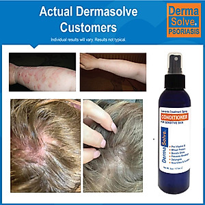Dermasolve Psoriasis Leave-In-Treatment and Styling Spray Conditioner for Seborrheic Dermatitis, Sensitive Skin, Detangle, De-Flake, Soothing Anti Dandruff, Dry Scalp Repair for Damaged Hair