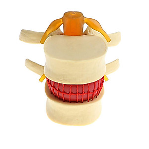 BONEW 4PCS Magnify 2X Human Spine Lumbar Vertebrae Degenerative Disc Medical Model