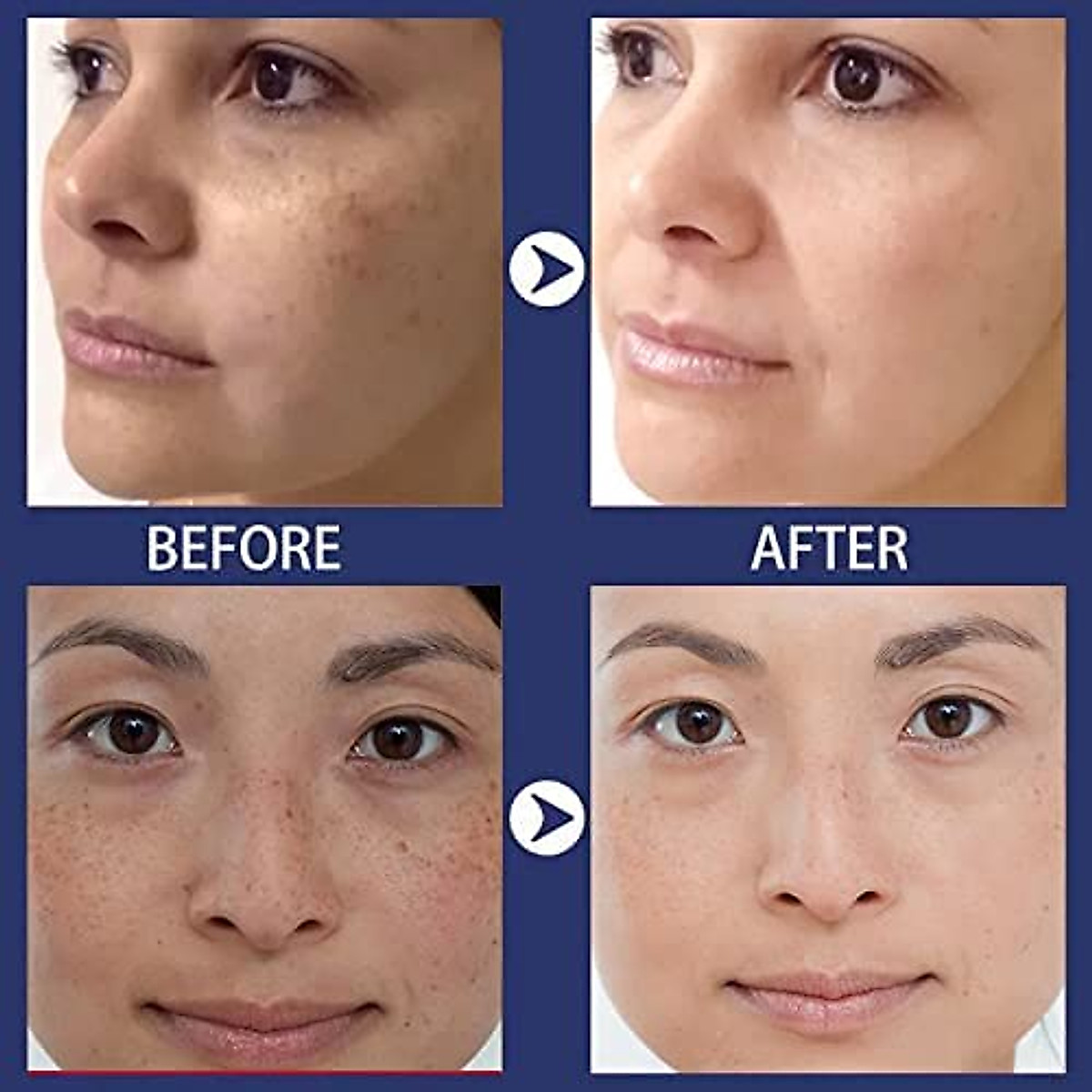 Inlifay Dark Spot Remover for Face Hyperpigmentation Treatment. Dark Spots, Melasma, Freckle, Sun Spots Removal Dark Spot Corrector Cream for Women and Men