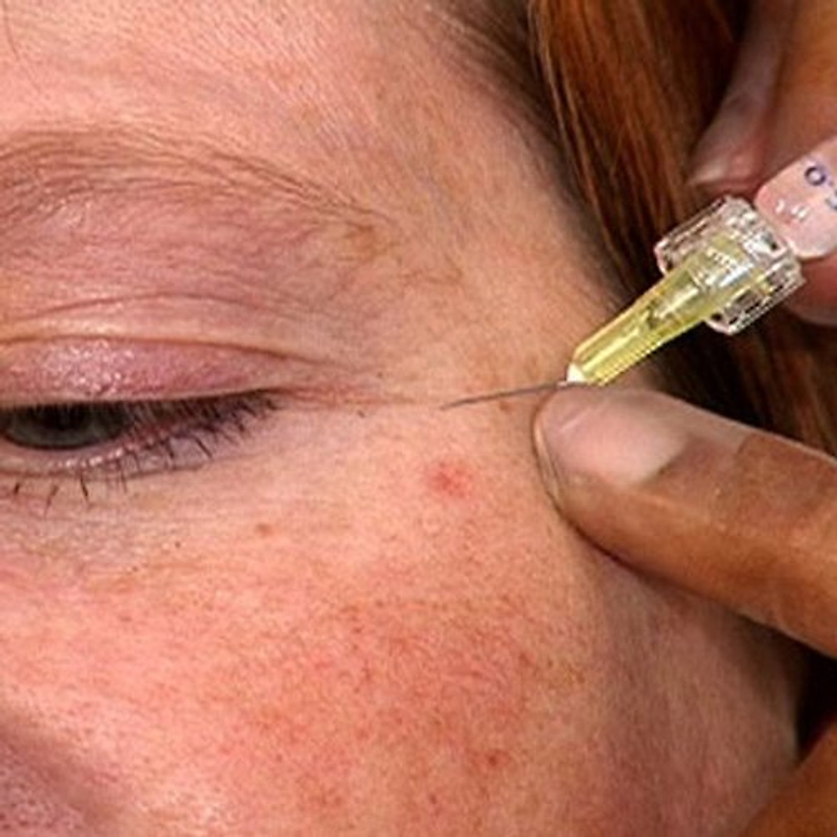 The Complete Guide to Dermal Filler Injections - Learn How To Inject Juvederm - Learn How To Inject Radiesse - This Advanced Radiesse Training Video / Juvederm Training Video Shows Injection Techniques for Medical Aesthetics Training