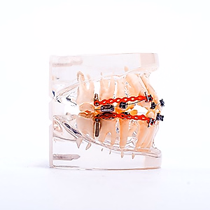Easyinsmile Dental Orthodontic Treatment Model Teeth/Tooth/Denture Model with Braces for Dentist Studying Researching and Patient Education (Metal Bracket)