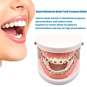 Angzhili 1 Piece Dental Demonstration Orthodontic Model with Metal Wires and Bracket (Metal bracket)