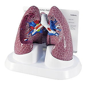 Lung Model Set | Human Body Anatomy Replica of Lung Cancer for Doctors Office Educational Tool | GPI Anatomicals