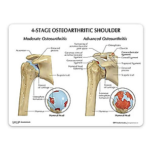 GPI Anatomicals Shoulder Joint Model Set | Human Body Anatomy Replica Set of 4-Stage Osteoarthritis Shoulder Joint for Doctors Office Educational Tool
