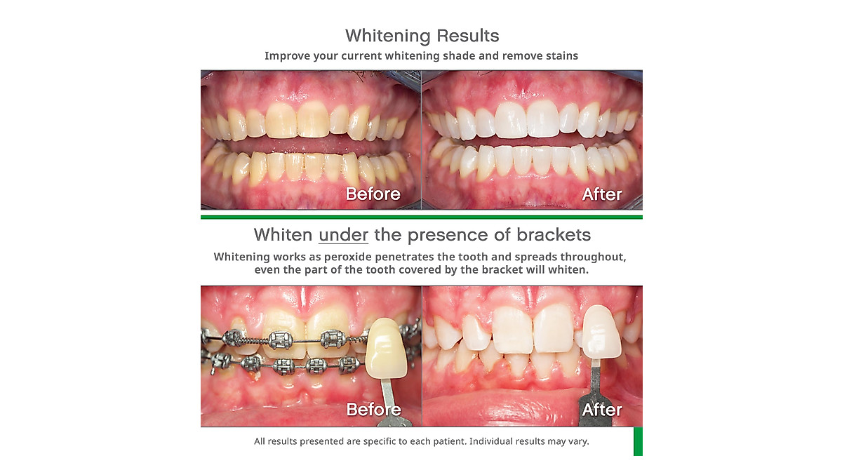 Opalescence Go Teeth Whitening Kit - 10 Mint Treatments