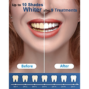 MySmile Teeth Whitening Gel Pen Refill Pack, 3 Non-Sensitive Teeth Whitening Pen, Deluxe Teeth Whitener Dental Grade Tooth Whitening Gel with Carbamide Peroxide for Home, 10 min Fast Result