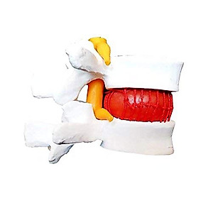 Doc.Royal Anatomical Human Lumbar Vertebrae Degenerative Lumbar Human Spine Model 1PCS