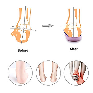 PCSsole 3/4 Orthotics Shoe Insoles High Arch Supports Shoe Insertsfor Plantar Fasciitis, Flat Feet, Over-Pronation, Relief Heel Spur Pain (XL:Men9-11/Women10-12)