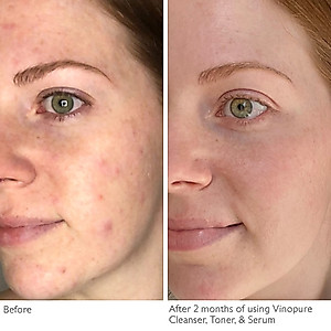 Caudalie Vinopure Natural Salicylic Acid Pore Minimizing Toner, 6.7 Ounce