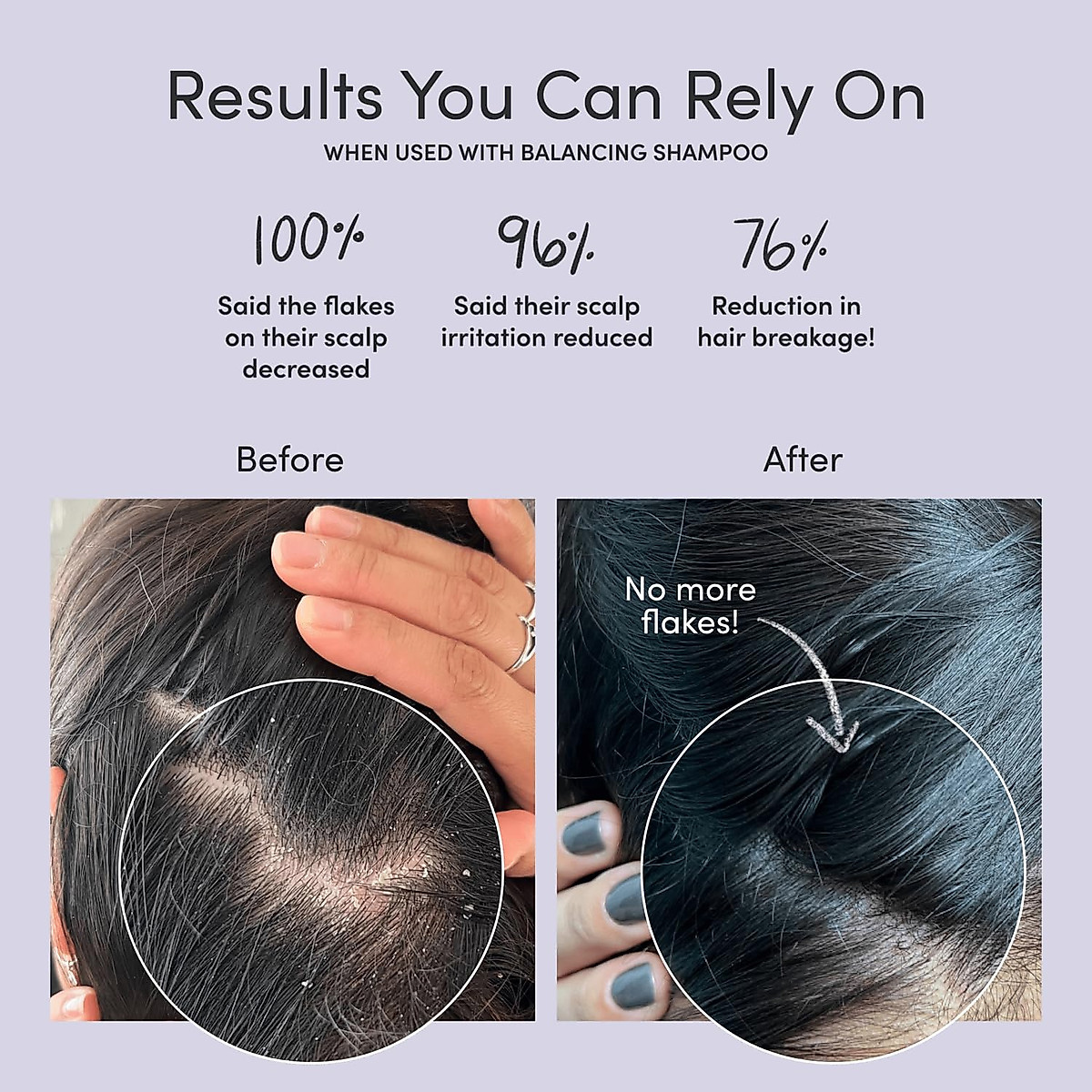 Jupiter Anti-Dandruff Scalp Serum, Leave-On Restoring Serum, for Dry, Itchy, & Oily Scalp, Aloe Vera, & Niacinamide, Color-Safe, Vegan, Cruelty-Free, Paraben, Phthalate, & Sulfate-Free, 3.4 fl oz