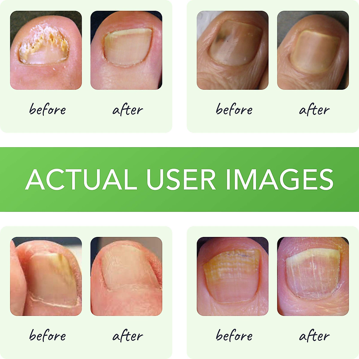 FUNGINIX Fungus Treatment - Toenail, Finger Fungus, and Foot Fungus Solution - Antifungal Spray - Made In the USA - Extra Strength (1 Bottle)