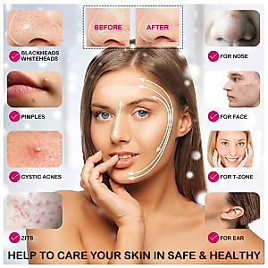 Blackhead Extractor, 6 Pack Pimple Popper Tool Kit for Removing Blackhead, Whitehead, Pimple, Acne, Zit, Comdone, Pores, Fat Granules on Nose, Face - with Organized Case