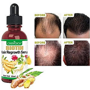5 PACK Ginger Oil for Hair Growth,Hair Growth Serum,Biotin Hair Growth Oil,Hair Growth Ginger Serum for Men and Women,Hair Growth Treatment,Hair Loss Treatment,Promotes Thicker,Growth Hair
