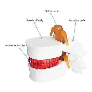 LVCHEN Disc Herniation Model - Human Lumbar Disc Herniation Spine Model 1.5X Intervertebral Disc Model Anatomical Vertebrae Disc Model with Elastic Software