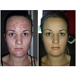 Instanly Ageless - Anti Wrinkle 5 Vials (.6mL Each)