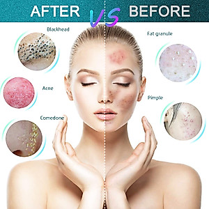 22PCS Blackhead Remover Tools, Acne Blemish Removal, Pimple Popper Extractor, Comedone Whitehead Zit Tweezers, Stainless Steel with Metal Case