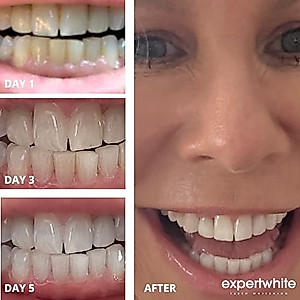 Expertwhite Teeth Whitening Gel Refills (6-gels). Made USA. 44 percent Carbamide Peroxide Tooth Bleaching Gel bleach For Invisalign style trays, Dental Grade Tooth Whitener. 6 syringes
