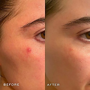 DIME Beauty Power Patch, 48 Count - Hydrocolloid Pimple Patches, Zit Spot Blemish Aid with Salicylic Acid, Vitamin A, and Clove Oil