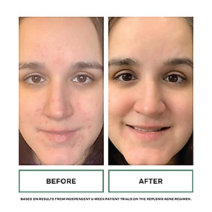 Replenix 10% Benzoyl Peroxide Wash, Advanced Acne Cleanser for Face and Body, 6.7 oz.