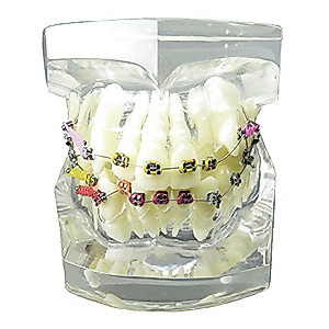 Smile1000 Dental Malocclusion Orthodontic Treatment Teeth Model with Metal Brackets Wires Colorful Ties Chains and Hoops M3005