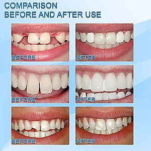 Dental Repair Denture Repair Beads,Tweezers,Dental Pick,Dental Tools for Fixing Filling Missing Broken Tooth Moldable Fake Teeth