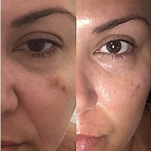 Dark Spot Corrector, Dark Spot Remover for Face, Melasma and Hyperpigmentation Treatment, Dark Spot Serum, Age Spot Remover, with Tyrostat, Kojic Acid, Alpha Arbutin, Mulberry Extract, Lactic Acid 1oz